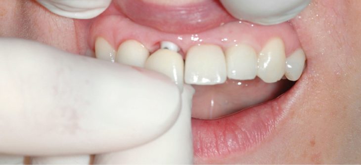 Les différentes solutions proposées pour remplacer une dent manquante ...